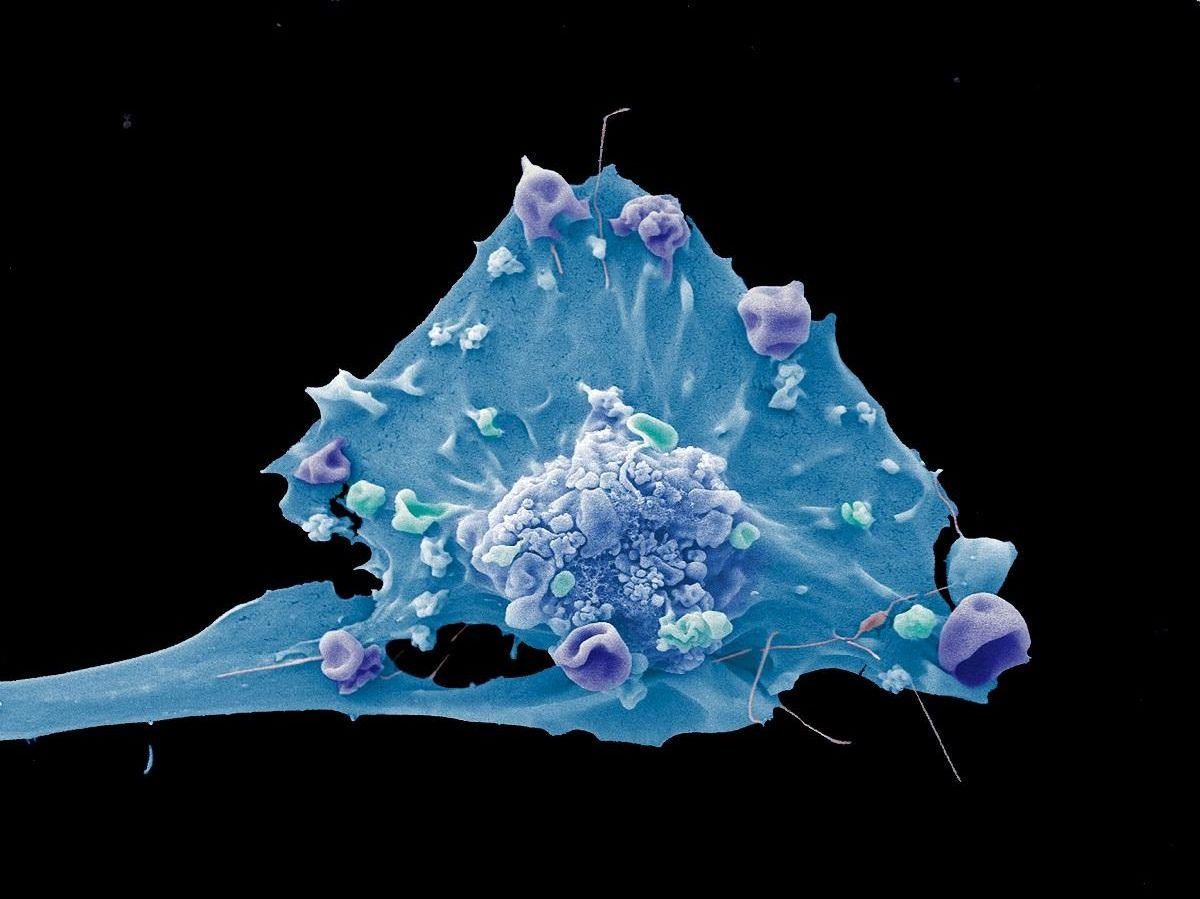 Breast cancer - Barts Cancer Institute - Queen Mary University of London