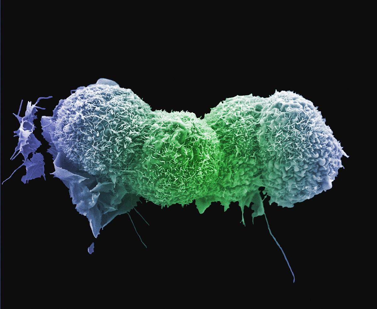 Tackling the deadliest cancer type - Barts Cancer Institute - Queen ...