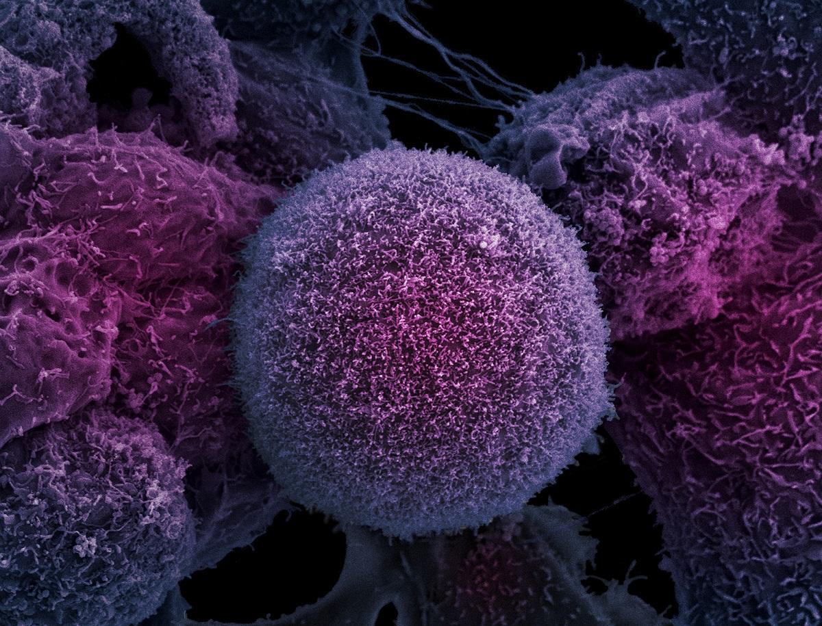 Prostate cancer - Barts Cancer Institute - Queen Mary University of London