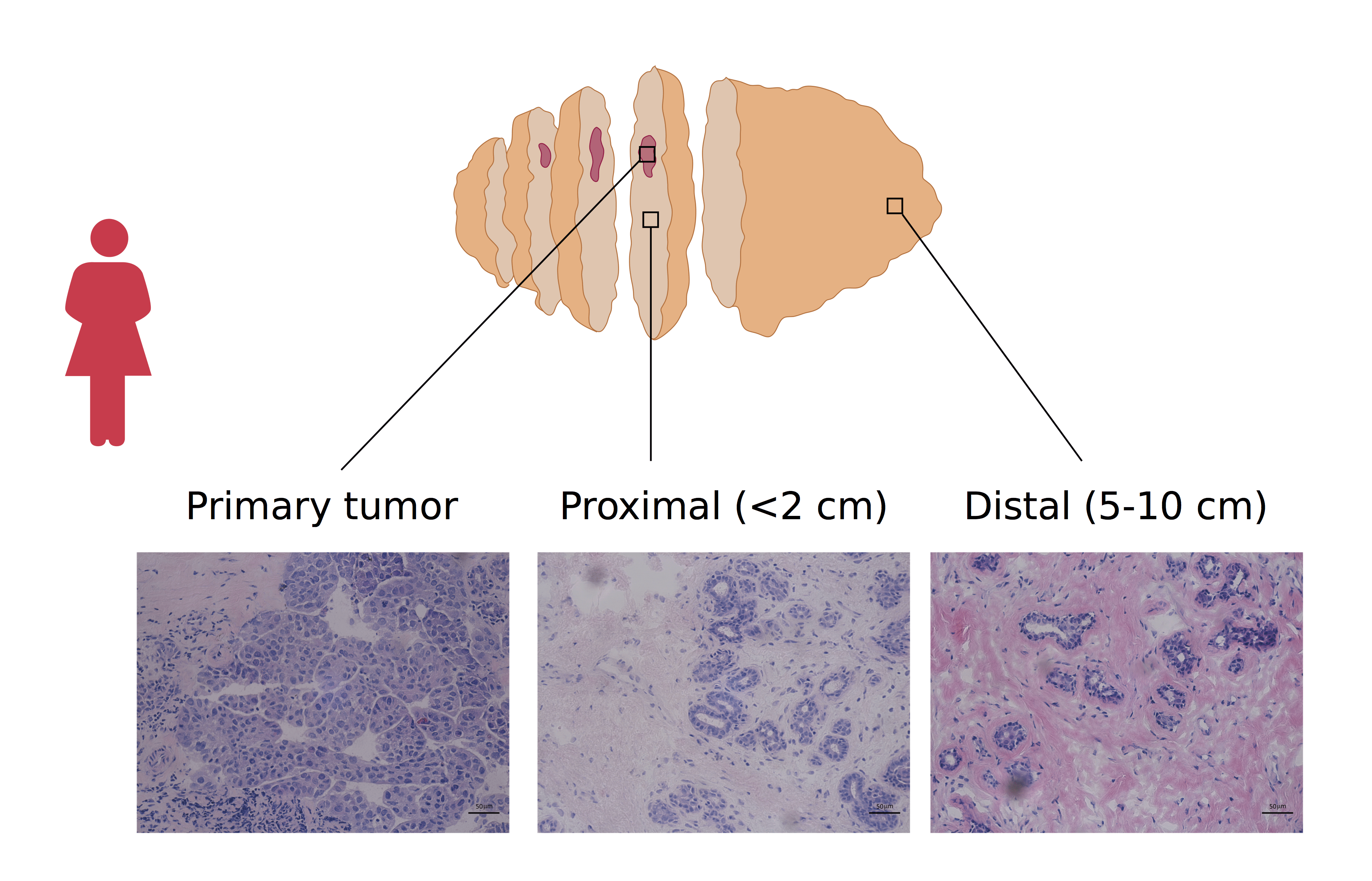 Biological clues in tissues surrounding breast tumours - Barts Cancer ...